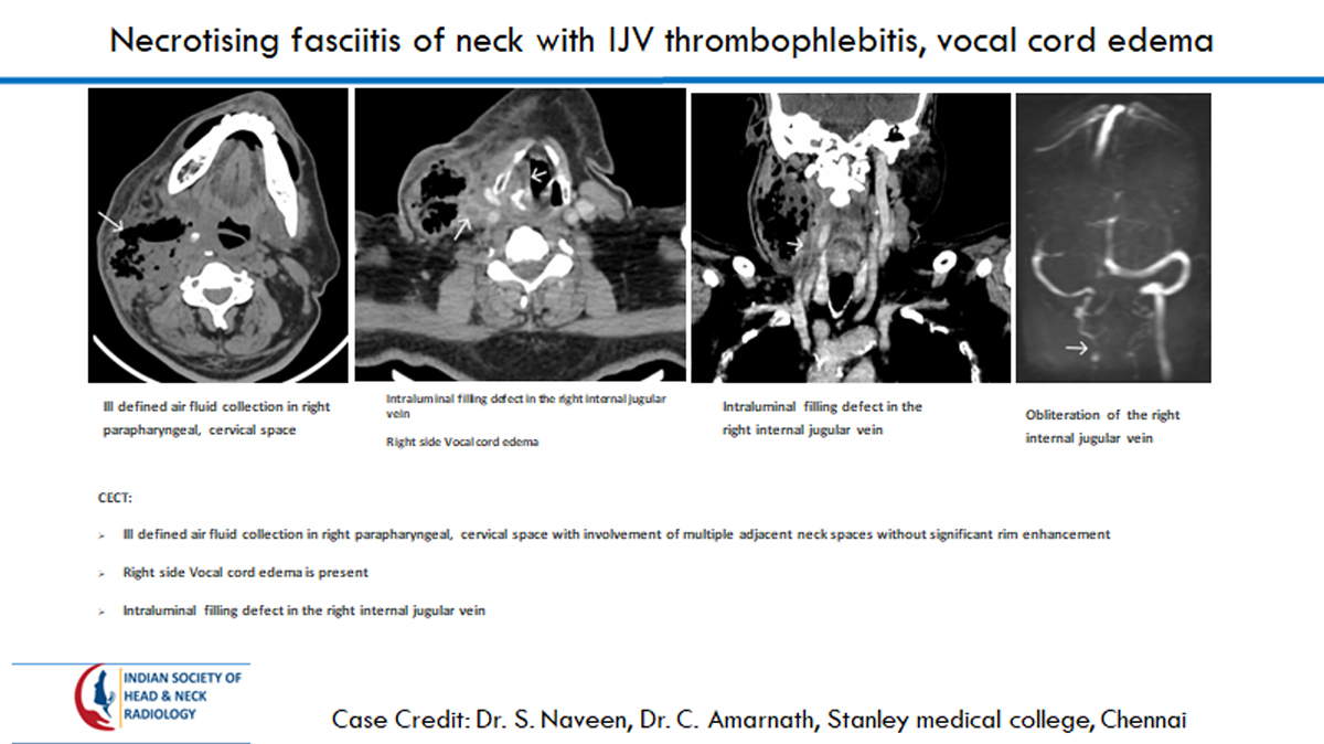 Case 33 - ISHNR