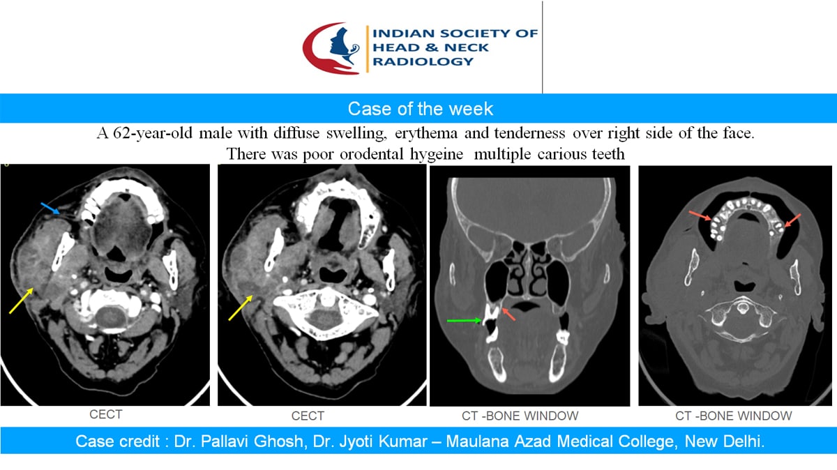 Case 43 - ISHNR