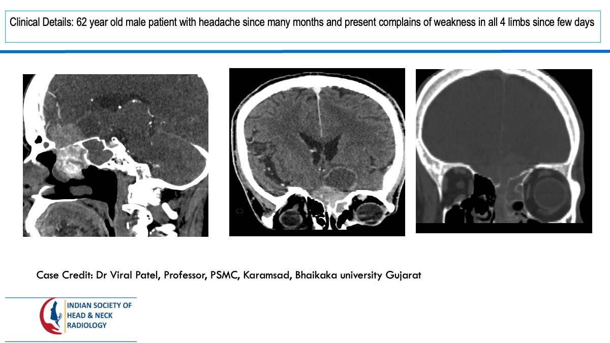 Case 102 - ISHNR