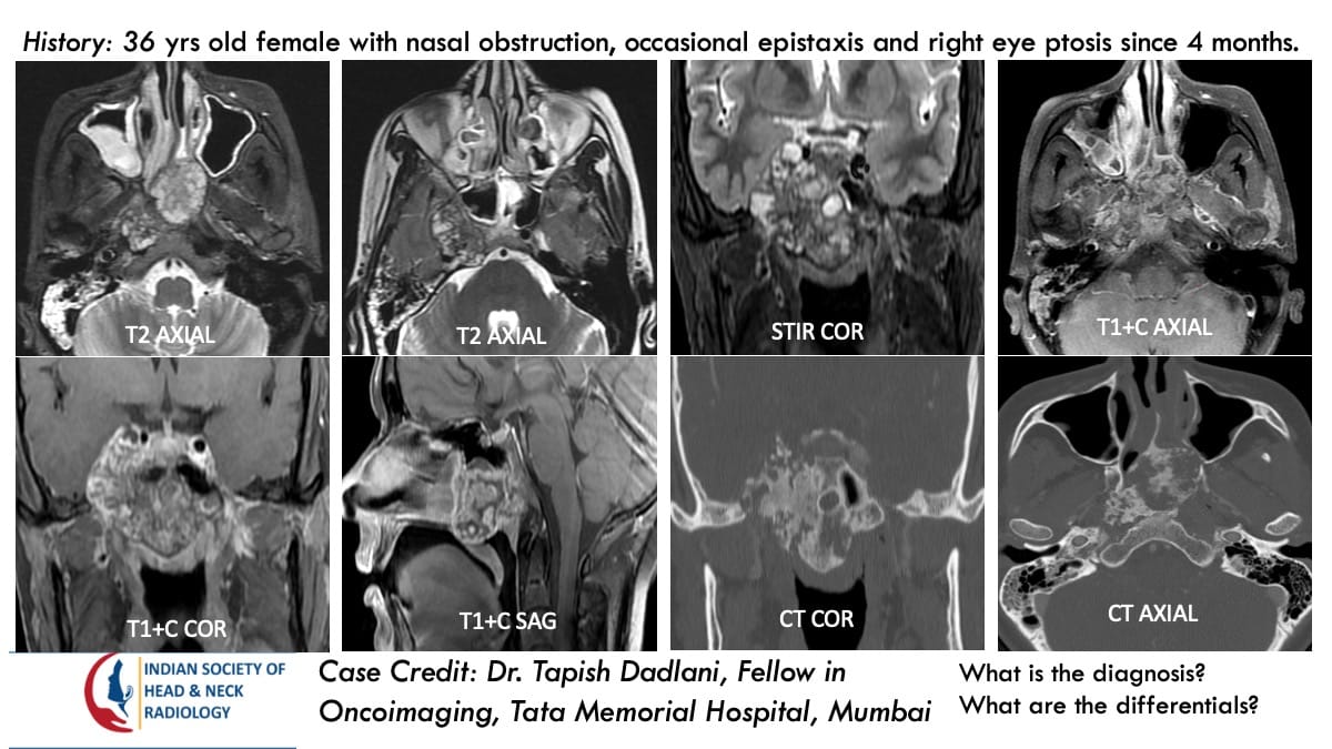 Case 103 - ISHNR