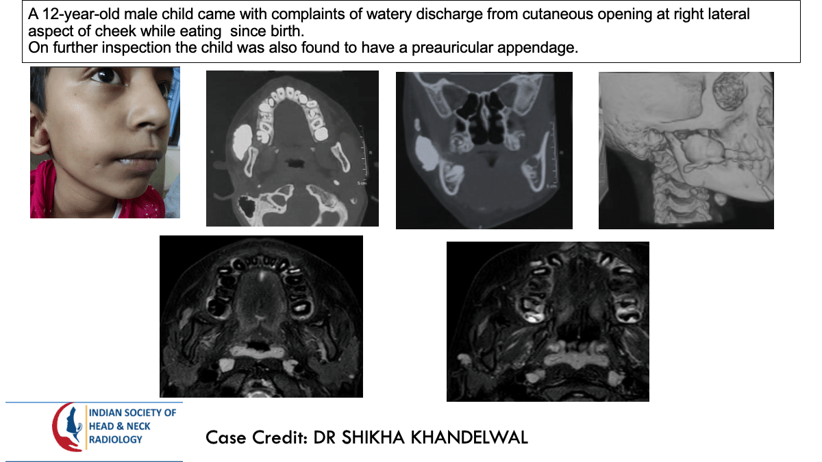 Case 110 - ISHNR